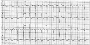 ASCVD - ASCVD & Lipidology Knowledge Hub